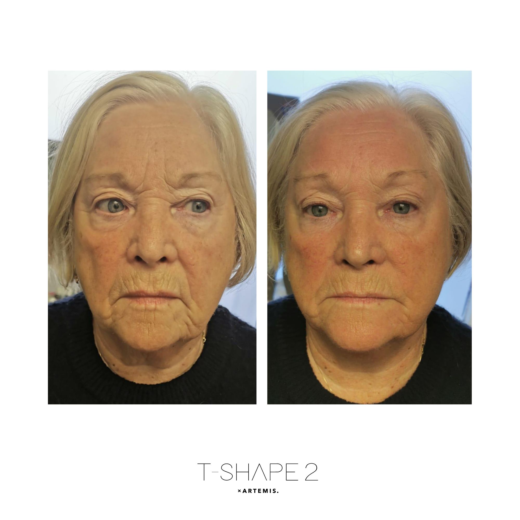 Body Contouring Near Me in Westminster, CO | iCRYO
